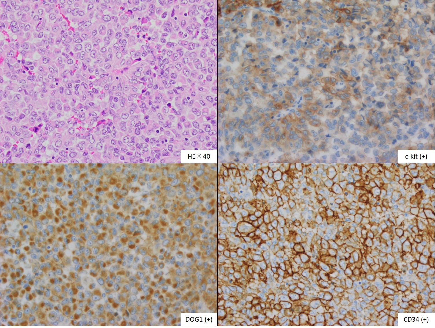 EUS-FNAで経験したGISTの1例 | 日本臨床細胞学会東海連合会